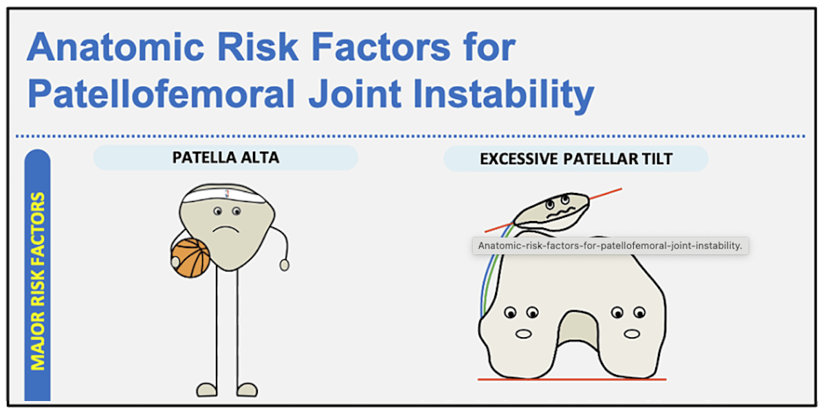 A Patellar Instability Infographic | Dr. Sabrina Strickland
